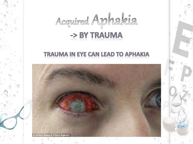 Aphakia,Causes ,Symptoms,signs,treatment | PPTX