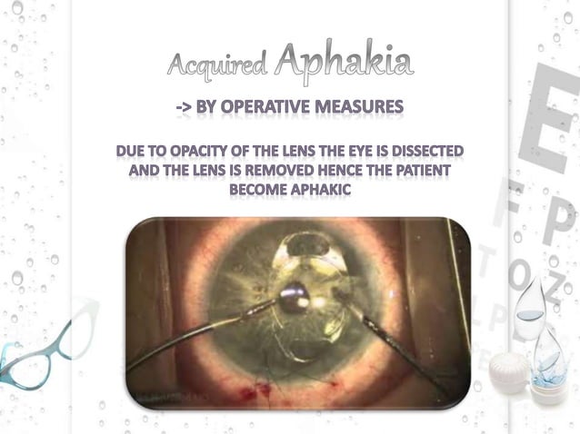 Aphakia,Causes ,Symptoms,signs,treatment | PPTX