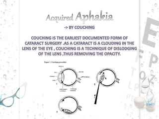 Aphakia,Causes ,Symptoms,signs,treatment | PPTX