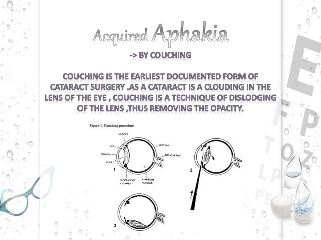 Aphakia,Causes ,Symptoms,signs,treatment | PPTX