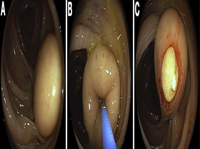 Colonoscopy made easy /Basic colonoscopy.pdf