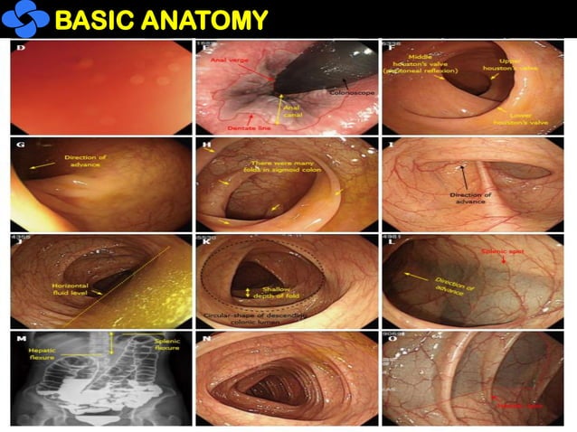 Colonoscopy made easy /Basic colonoscopy.pdf
