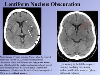 Basic concepts of computed tomography scan of the brain 2.ppt