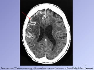 Basic concepts of computed tomography scan of the brain 2.ppt