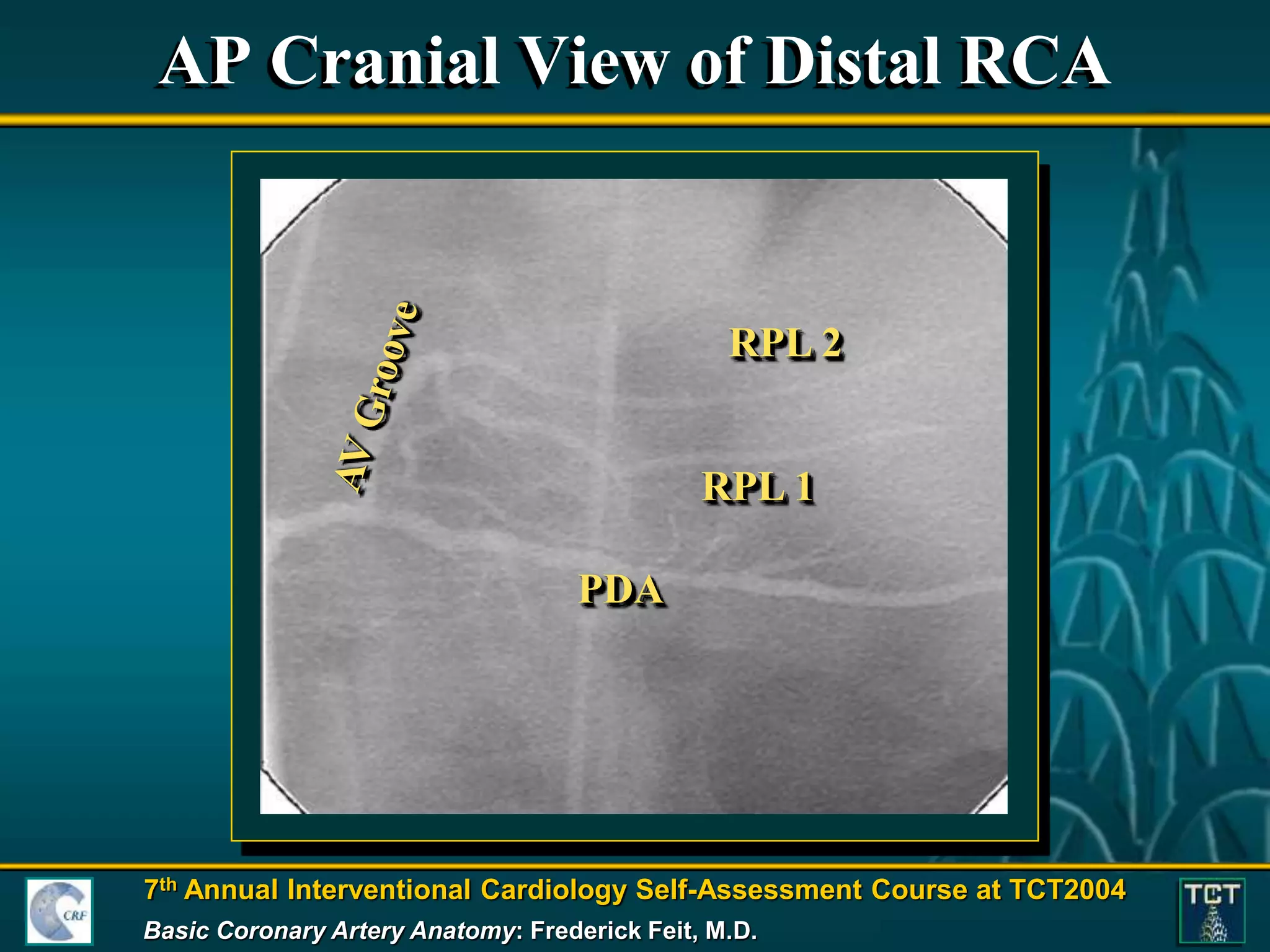 Basic Coronary Anatomy - Paul Fefer, MD..ppt