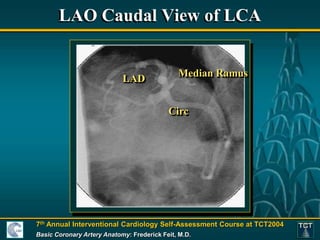 Basic Coronary Anatomy - Paul Fefer, MD..ppt