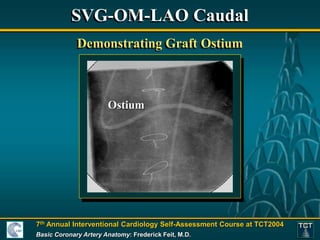 Basic Coronary Anatomy - Paul Fefer, MD..ppt