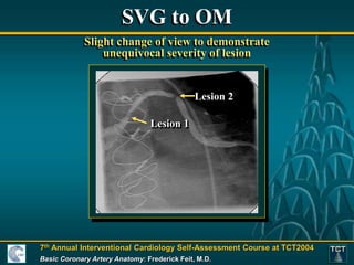 Basic Coronary Anatomy - Paul Fefer, MD..ppt