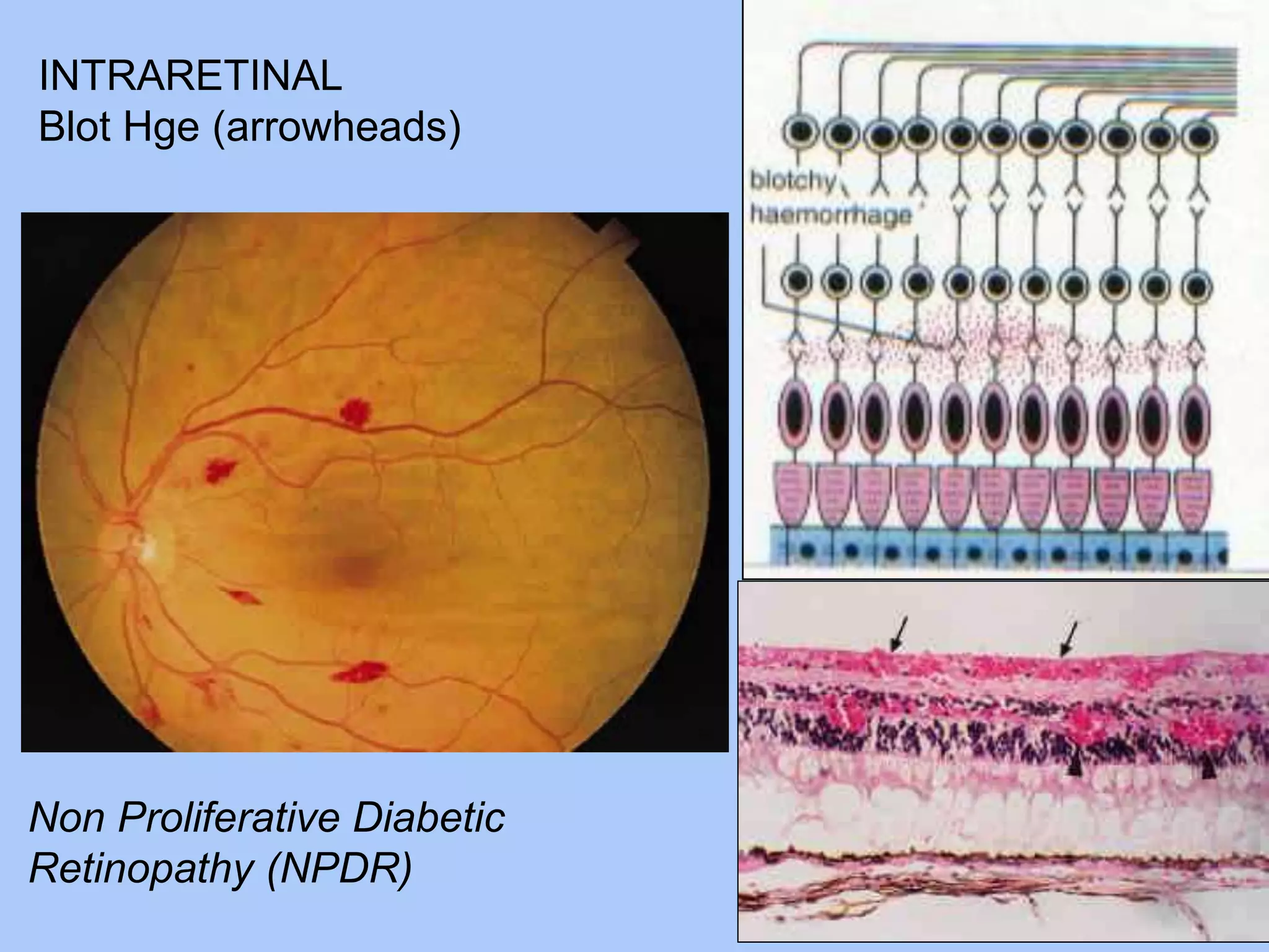 Pathology of Retina and Vitreous | PPTX