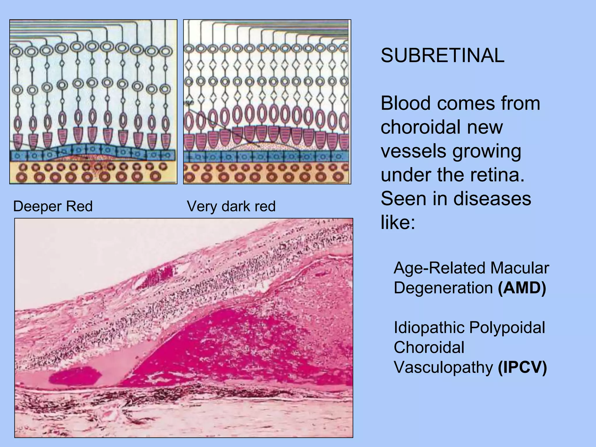 Pathology of Retina and Vitreous | PPTX