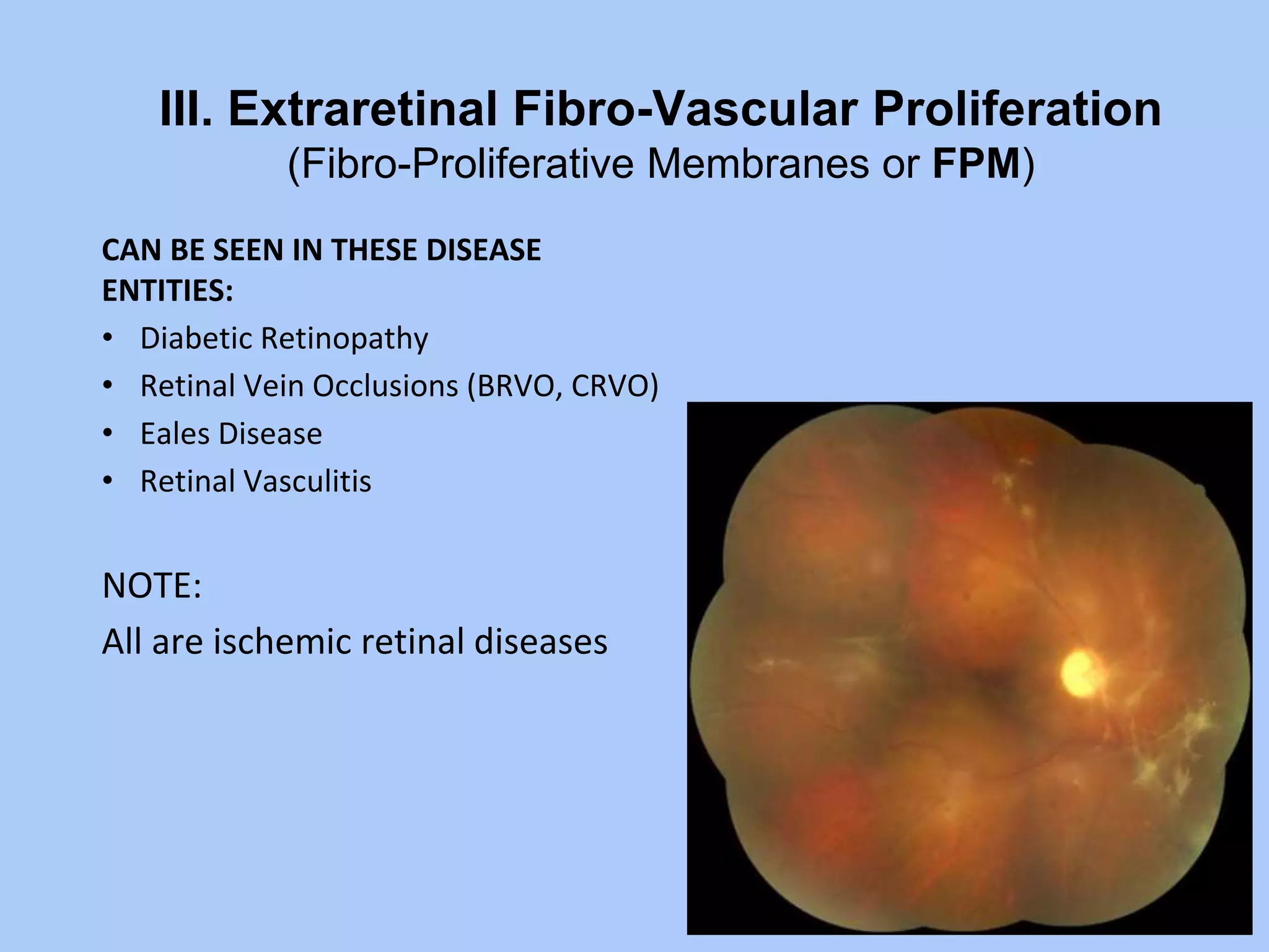 Pathology of Retina and Vitreous | PPTX