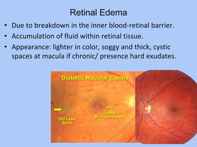 Pathology of Retina and Vitreous | PPTX