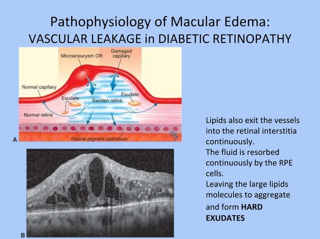 Pathology of Retina and Vitreous | PPTX