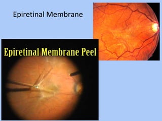 Pathology of Retina and Vitreous | PPTX