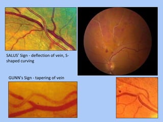 Pathology of Retina and Vitreous | PPTX