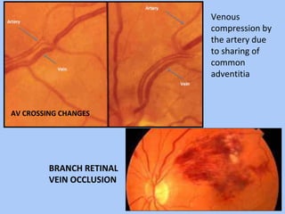 Pathology of Retina and Vitreous | PPTX