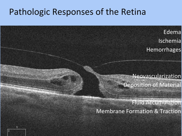 Pathology of Retina and Vitreous | PPTX