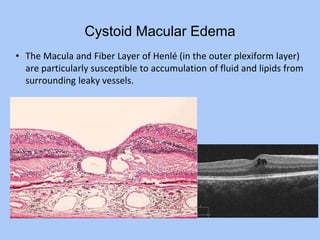 Cystoid Macular Edema Histology