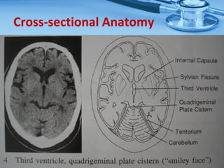 Basic ct brain and rapid CT interpretation | PPT