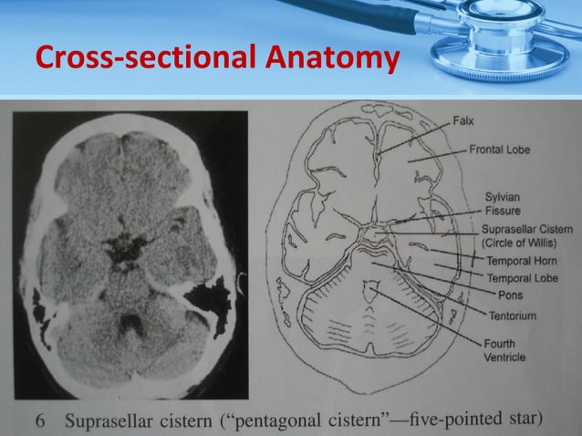 Basic ct brain and rapid CT interpretation | PPT