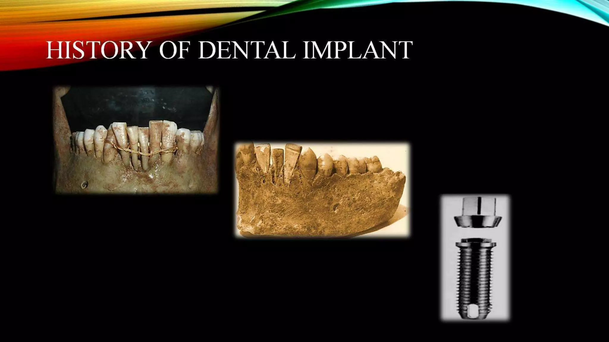 Basic dental implant | PPTX