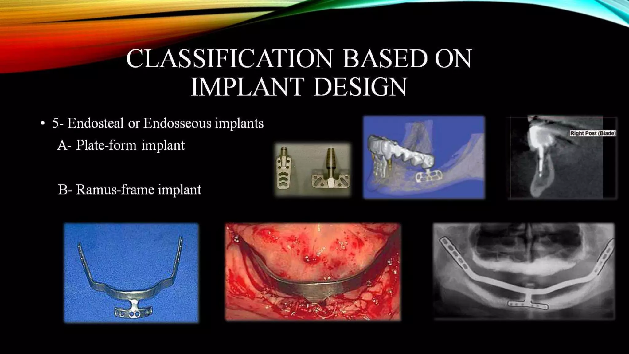 Basic dental implant | PPTX