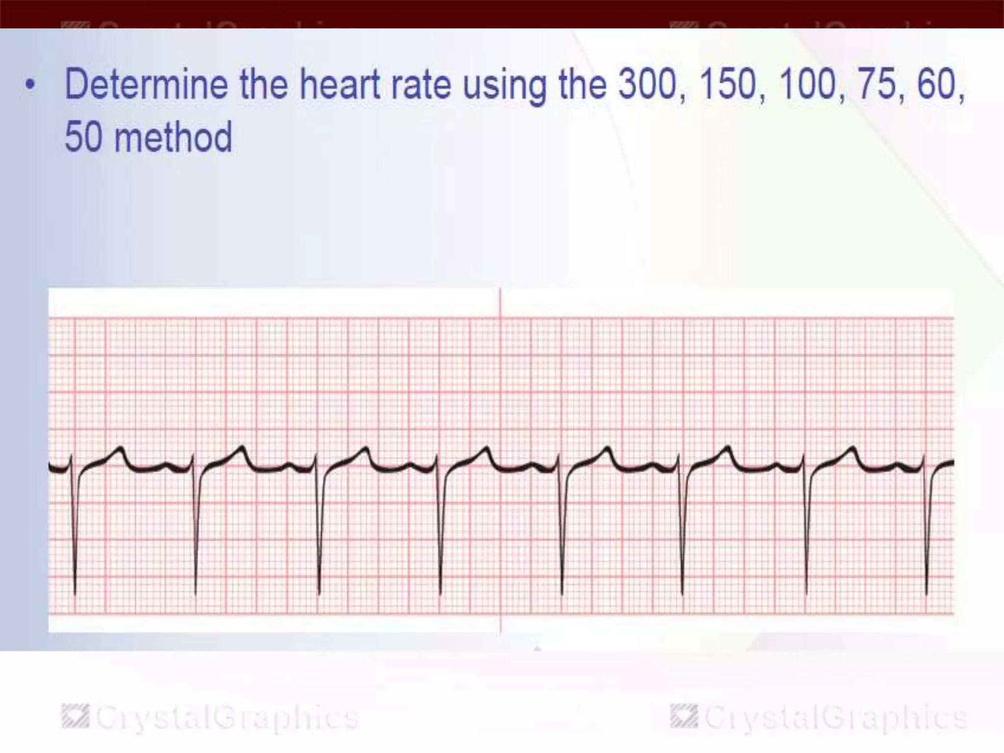 Basic dysrhythmia interpretation | PPTX