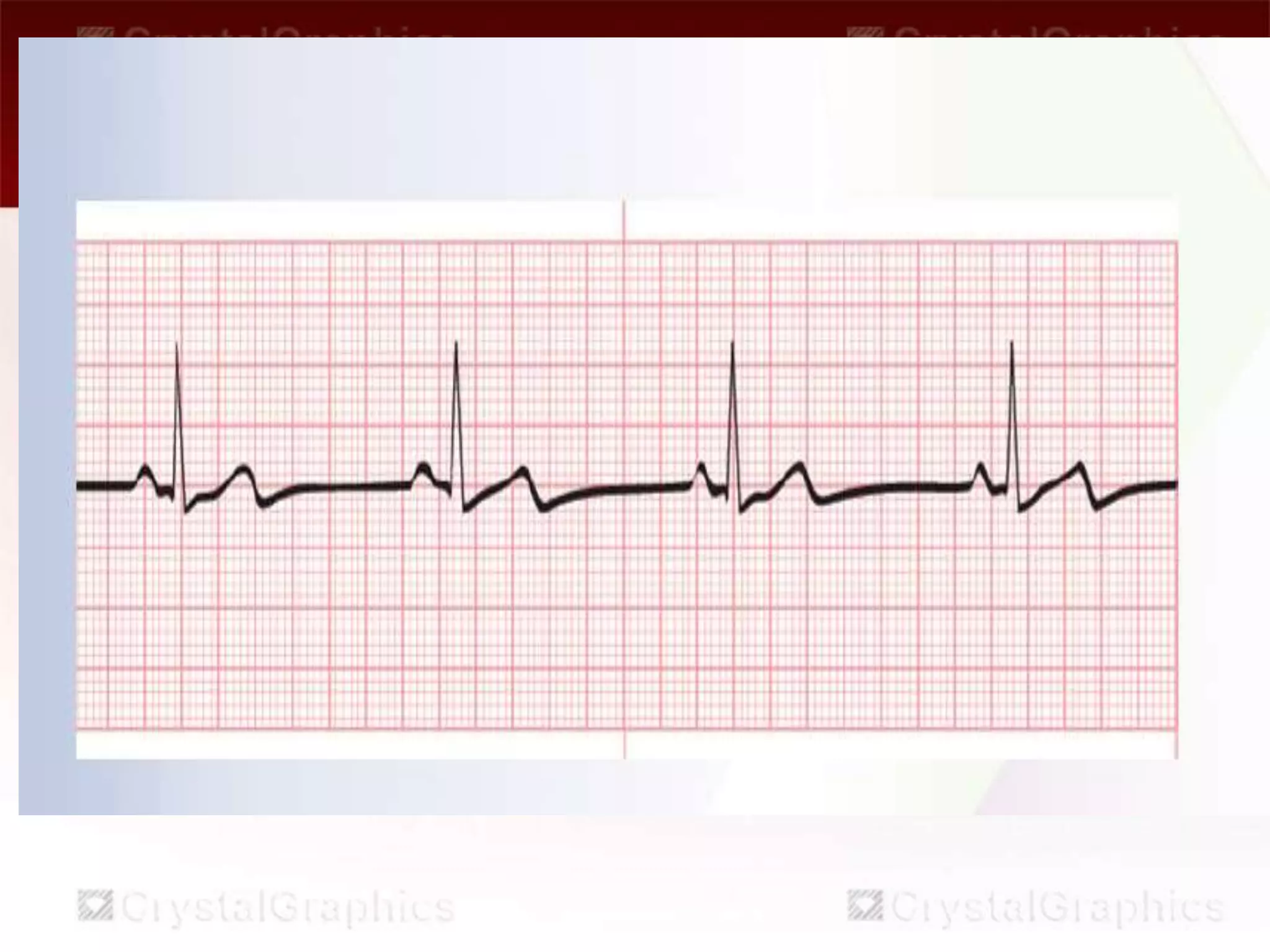 Basic dysrhythmia interpretation | PPTX