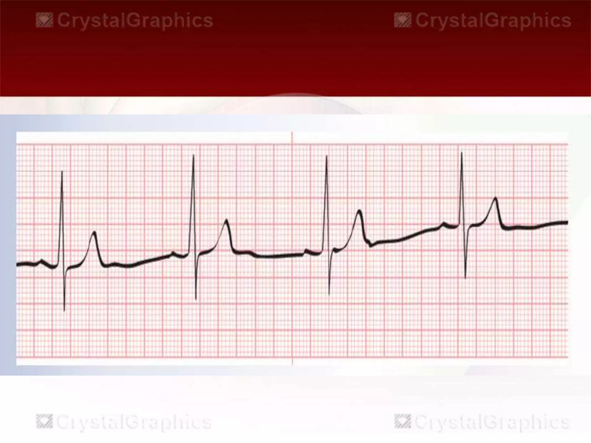 Basic dysrhythmia interpretation | PPTX