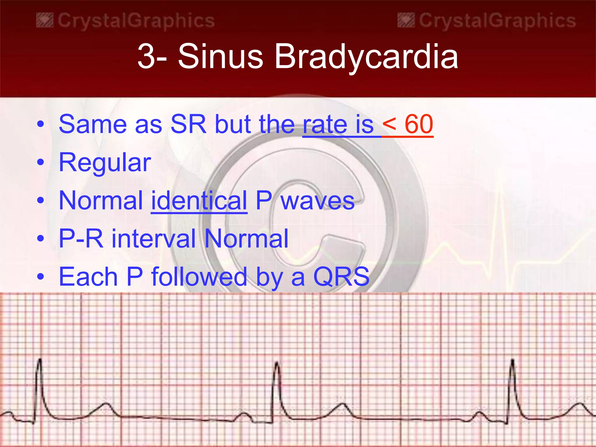 Basic dysrhythmia interpretation | PPTX