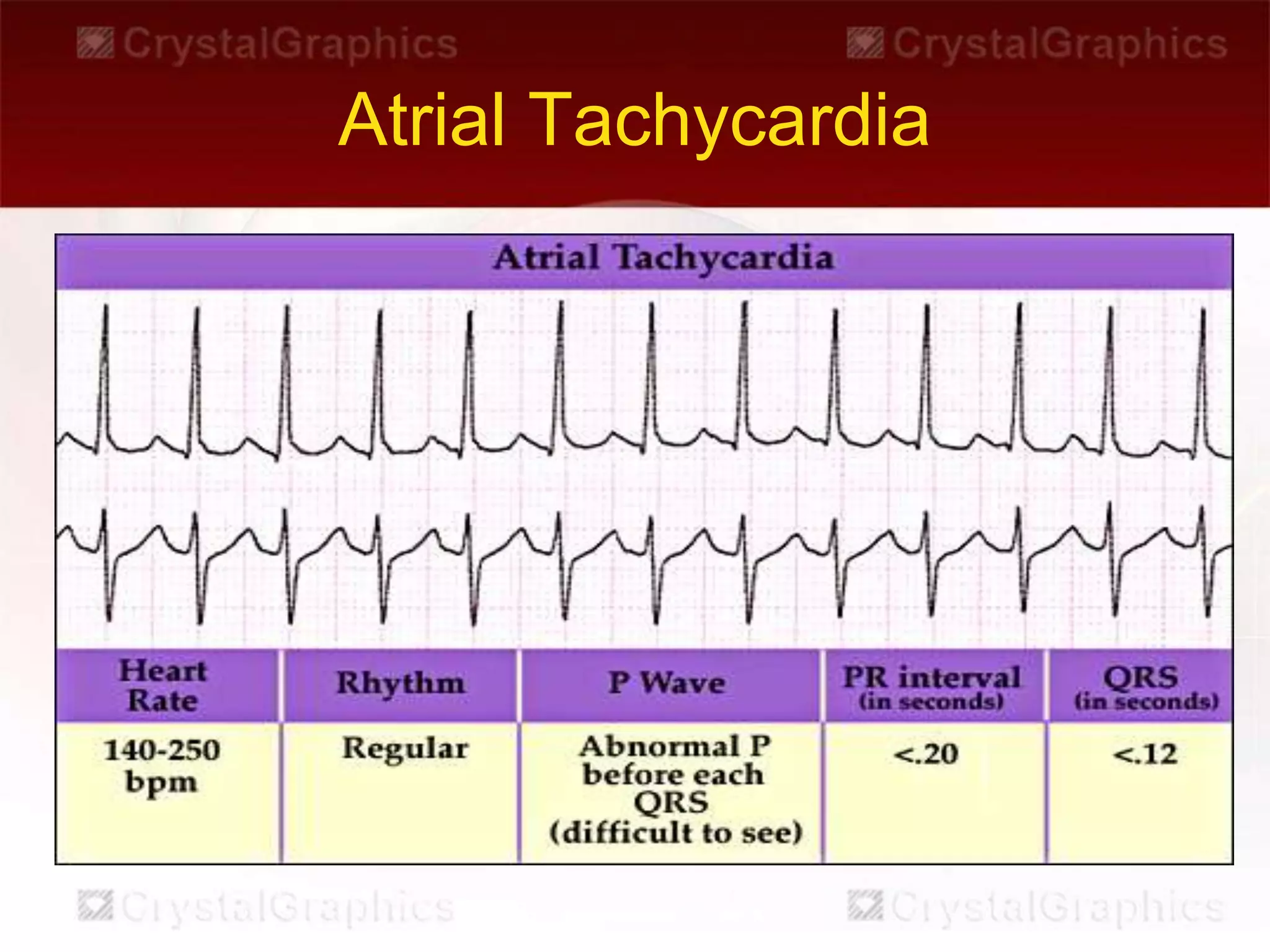 Basic dysrhythmia interpretation | PPTX