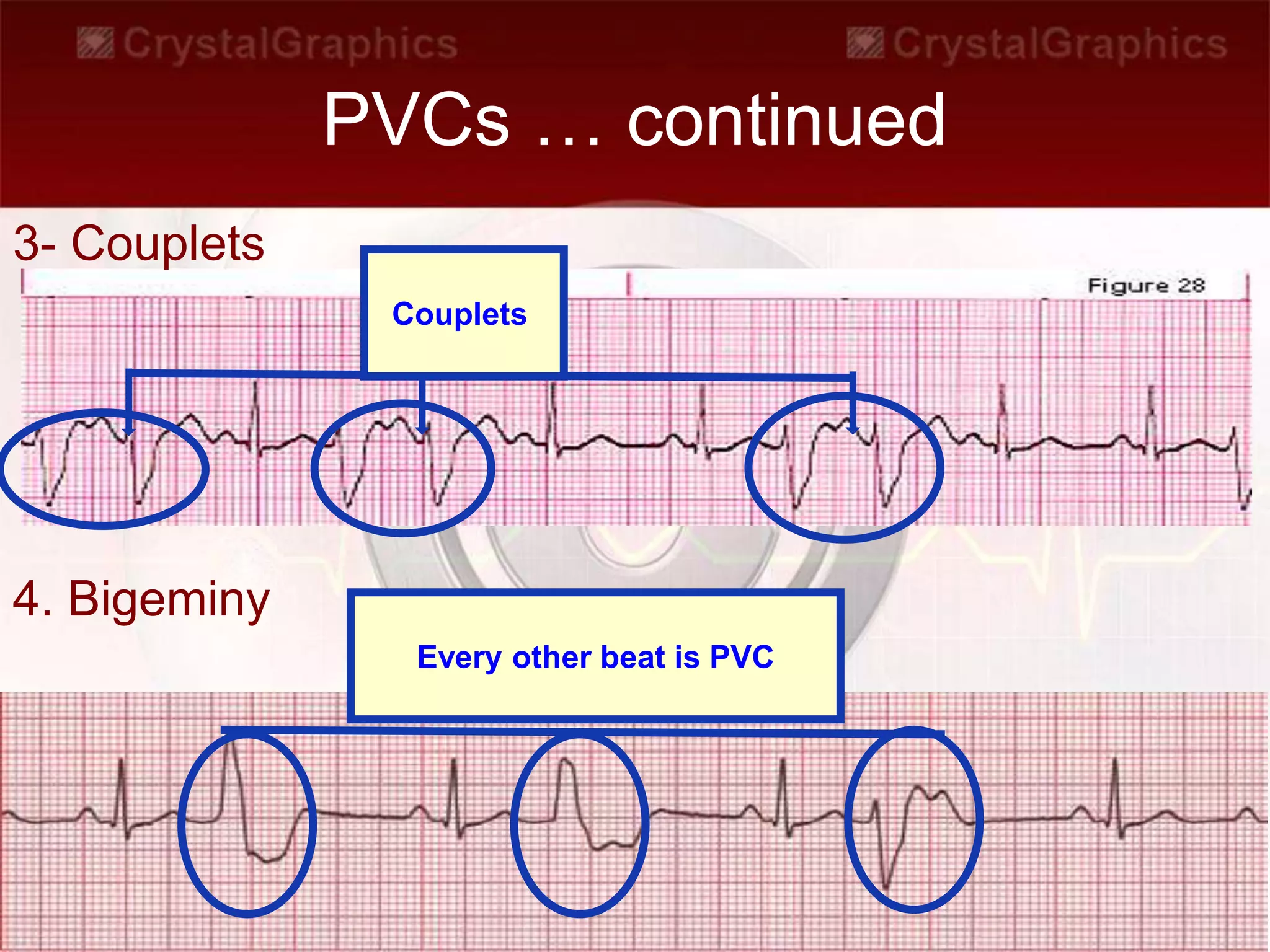 Basic dysrhythmia interpretation | PPTX