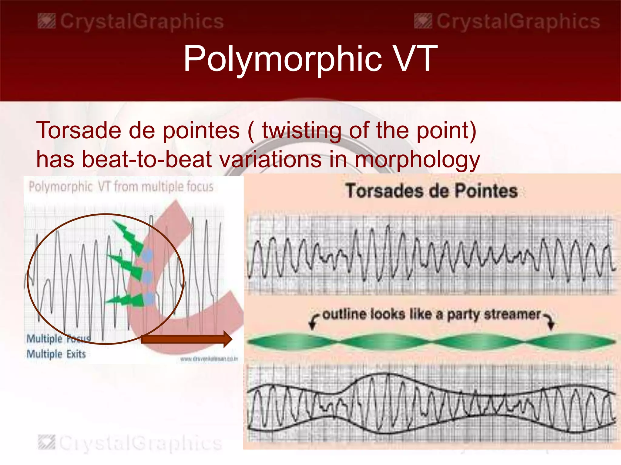 Basic dysrhythmia interpretation | PPTX