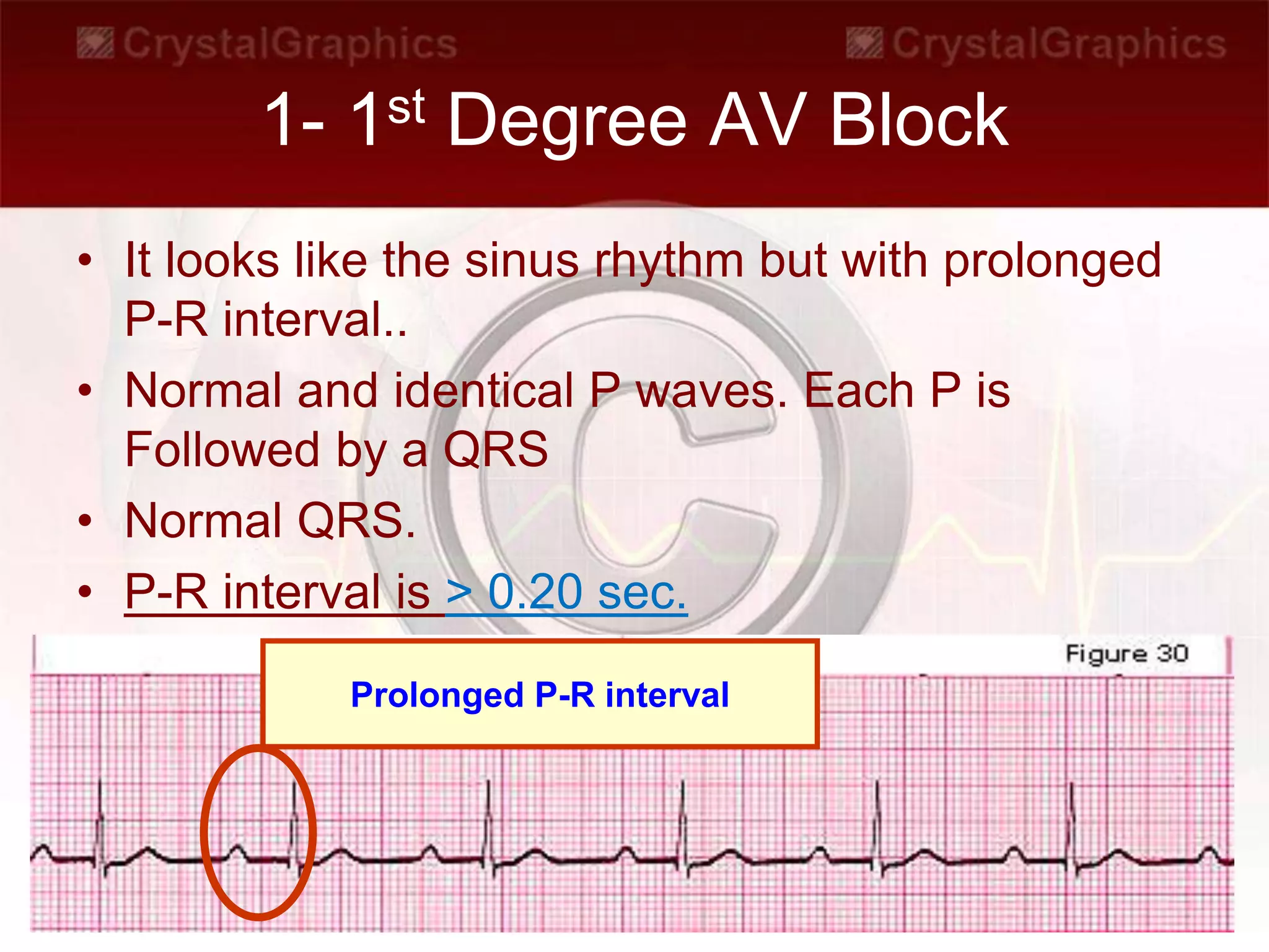 Basic dysrhythmia interpretation | PPTX