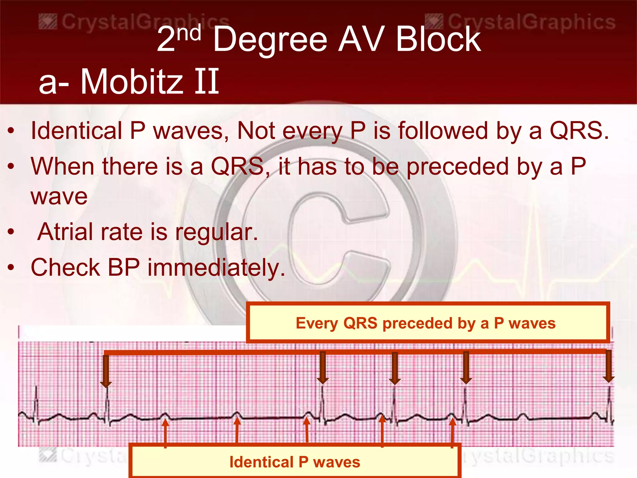 Basic dysrhythmia interpretation | PPTX