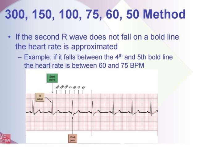 Basic dysrhythmia interpretation | PPTX | Heart and Cardiovascular Diseases | Diseases and ...