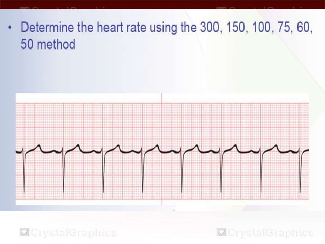 Basic dysrhythmia interpretation | PPTX | Heart and Cardiovascular ...