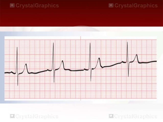 Basic dysrhythmia interpretation | PPTX | Heart and Cardiovascular ...
