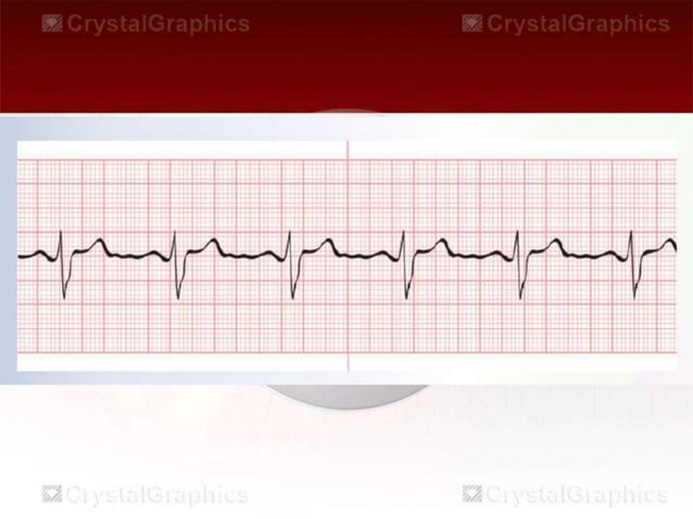 Basic dysrhythmia interpretation | PPTX | Heart and Cardiovascular ...