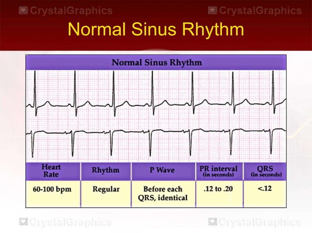 Basic dysrhythmia interpretation | PPTX | Heart and Cardiovascular ...