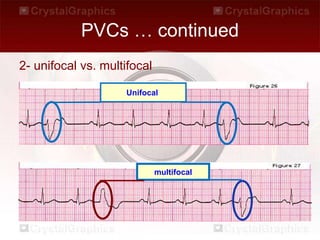 Basic dysrhythmia interpretation | PPT