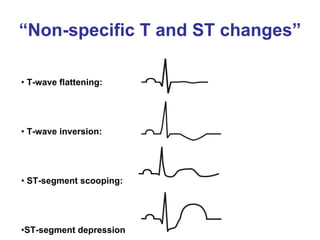 Basic Ecg | PPT