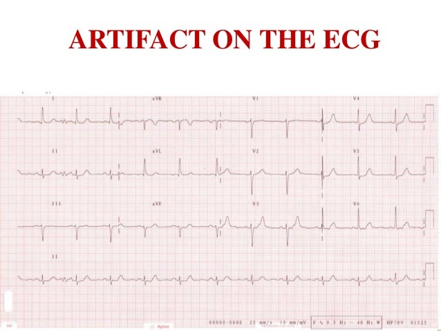 Basic ecg