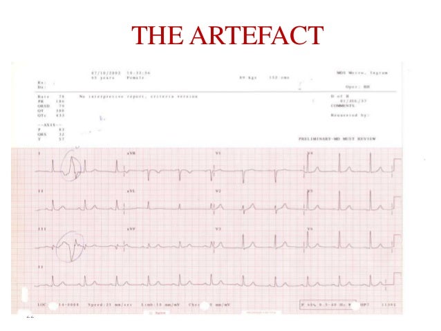 Somatic Tremor Artifact