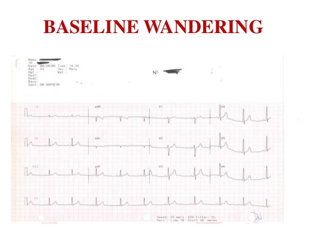 Basic ecg