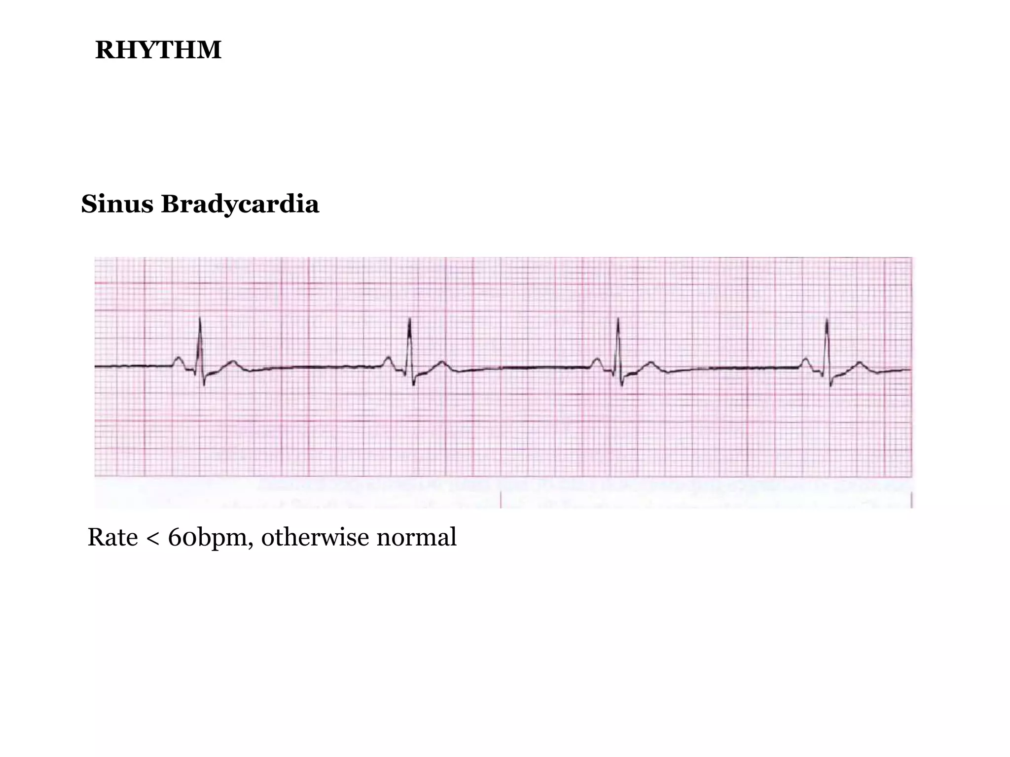Basic ecg | PPT