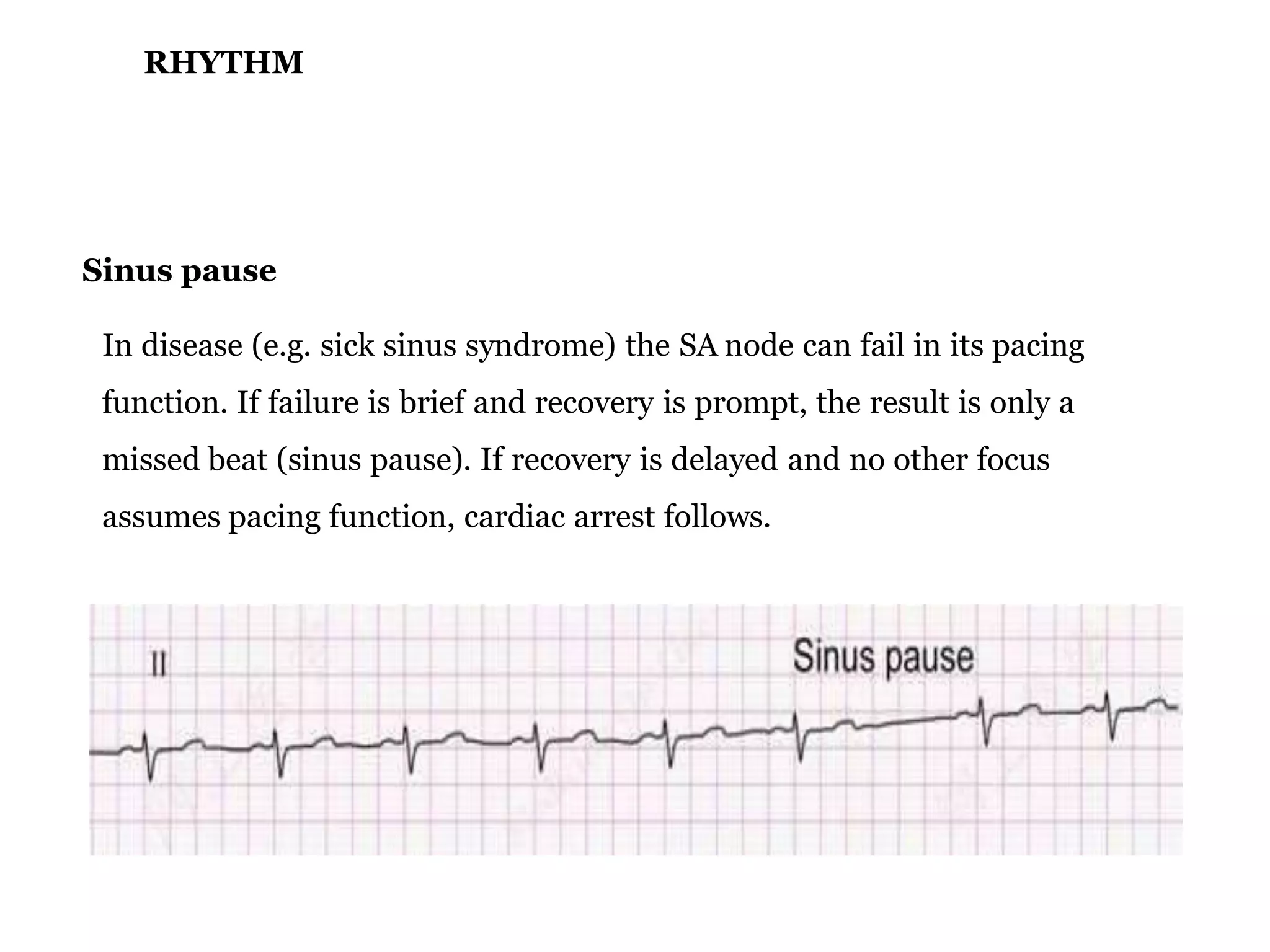 Basic ecg | PPT
