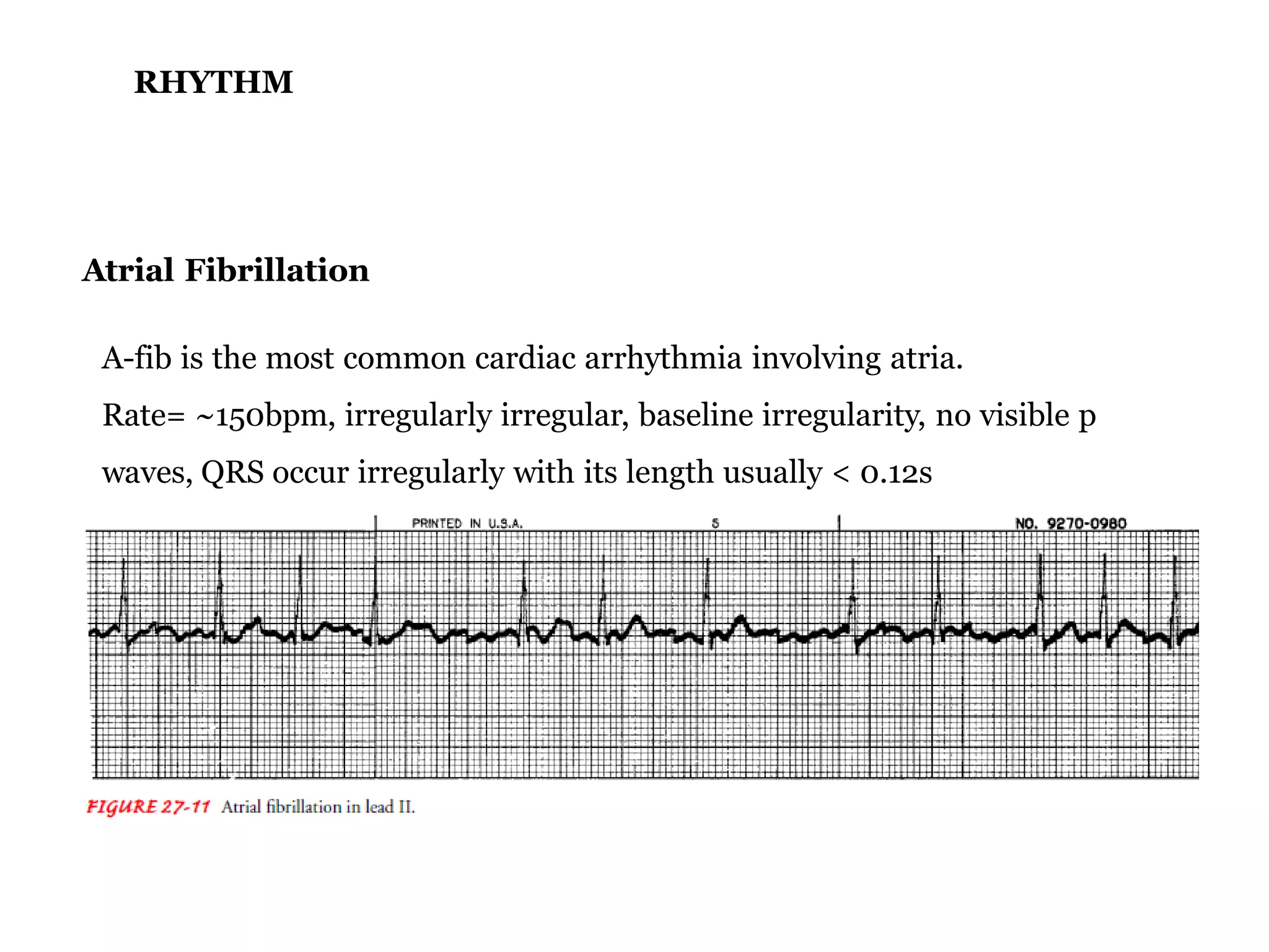 Basic ecg | PPTX