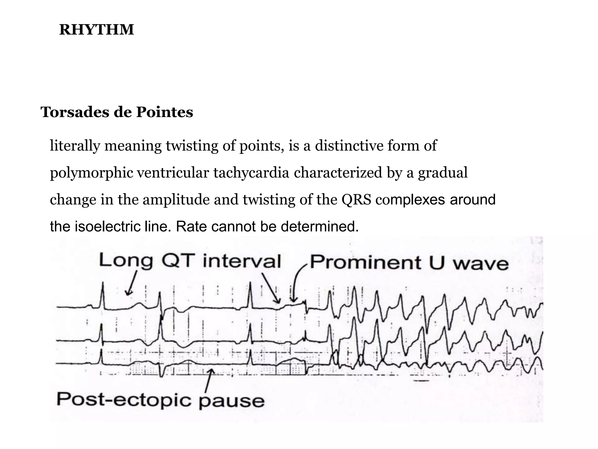 Basic ecg | PPTX