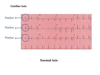 Basic ecg | PPTX